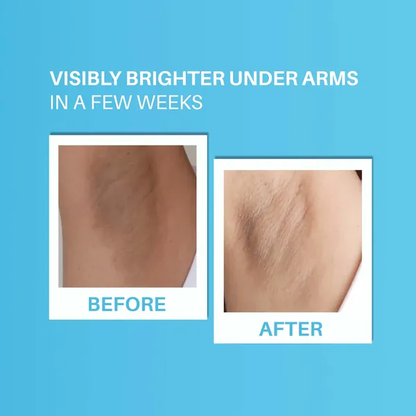 5% Glycolic Acid Brightens Skin and Treat Discoloration Underarm ...